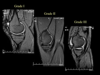 MRI Knee - Basics | PPT