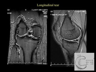 MRI Knee - Basics | PPT
