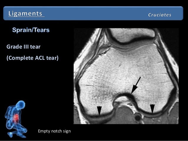 Mri knee 3
