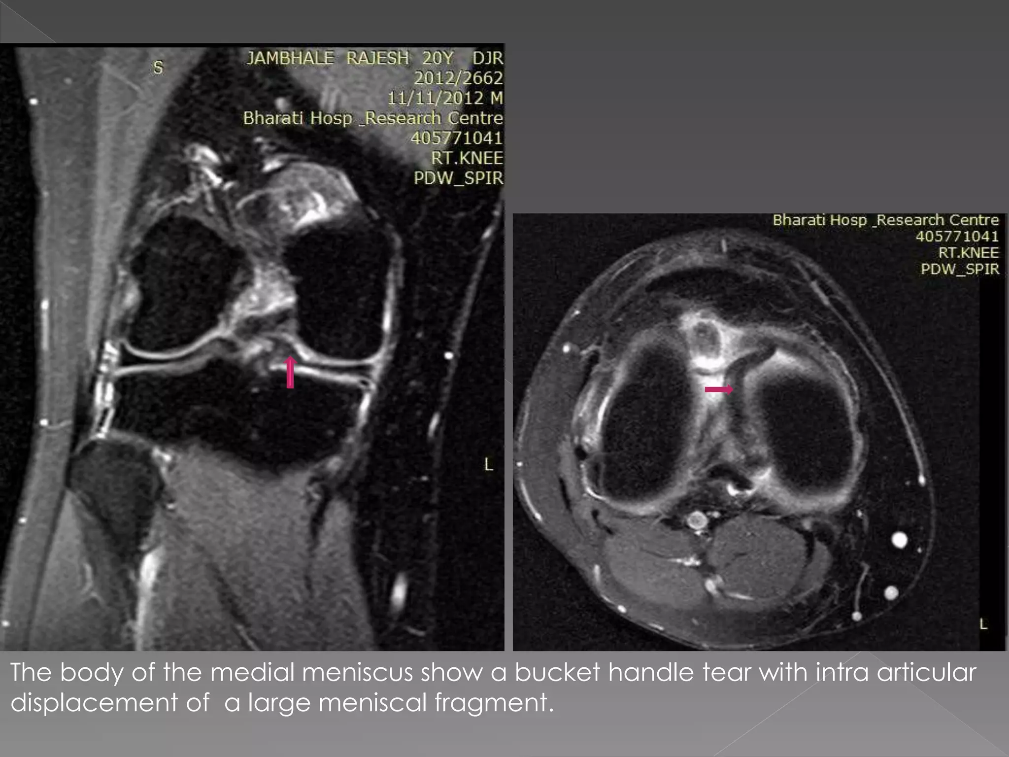 Mri knee trauma | PPTX