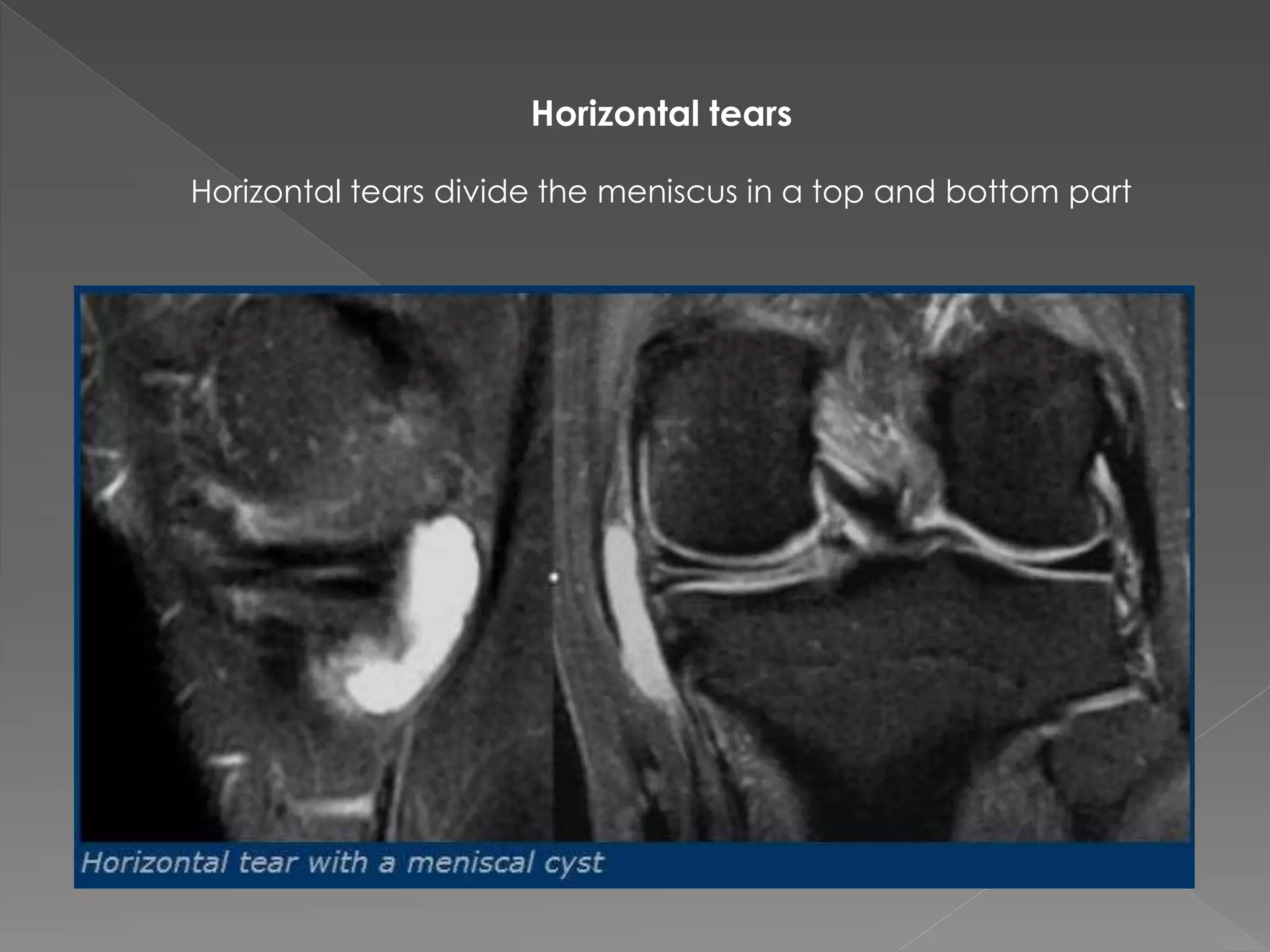 Mri knee trauma | PPTX