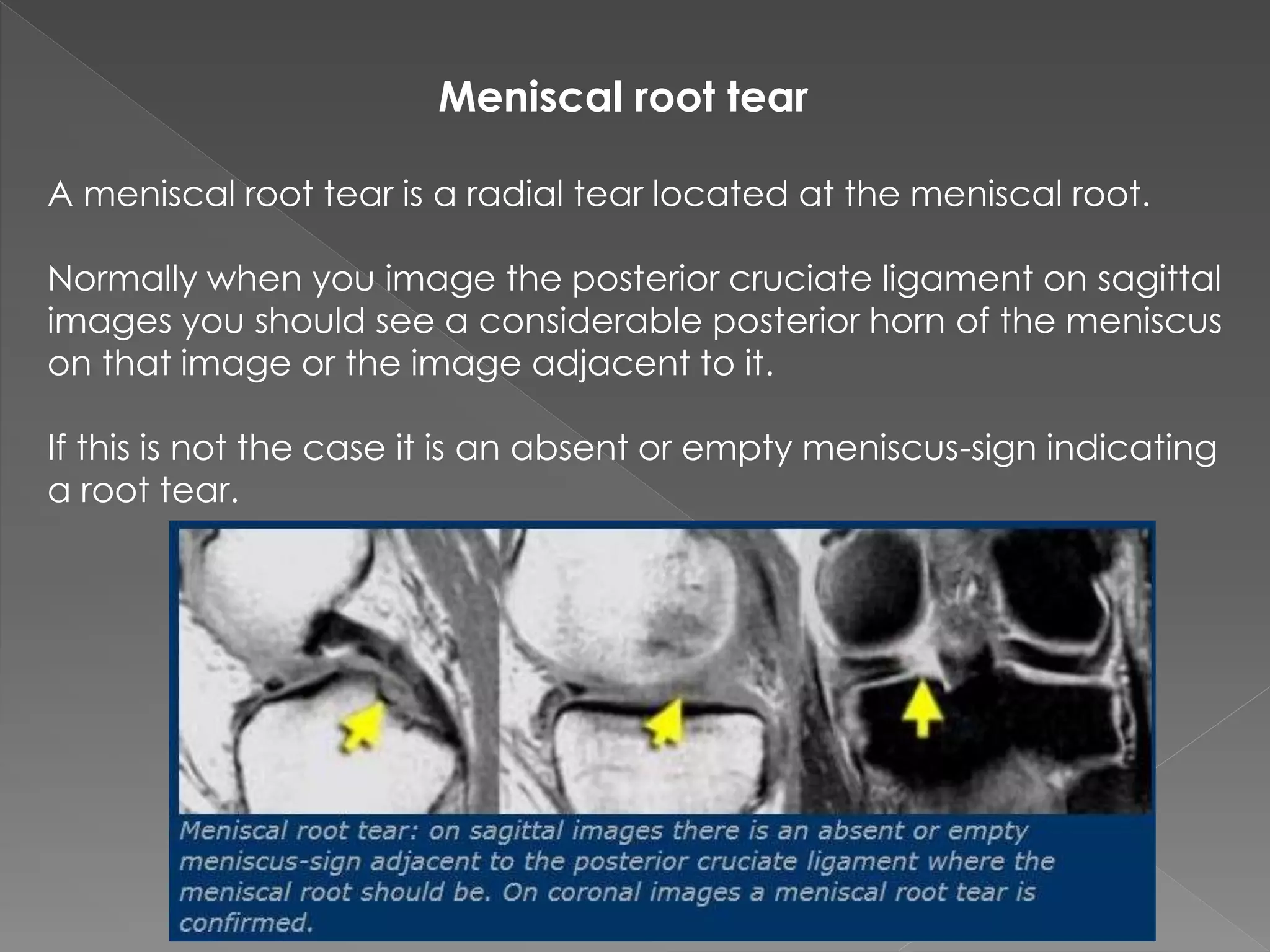 Mri knee trauma | PPTX