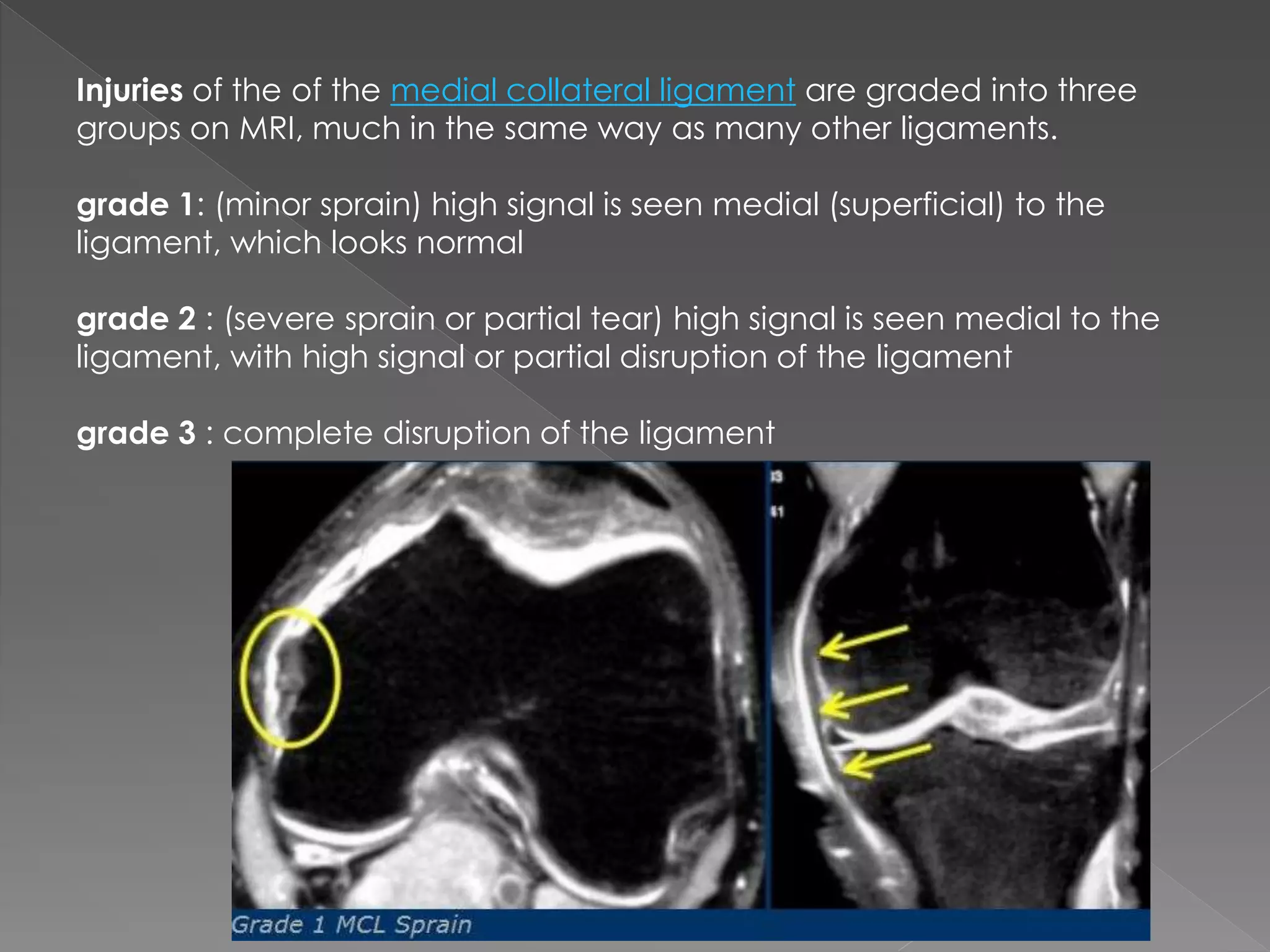 Mri knee trauma | PPTX