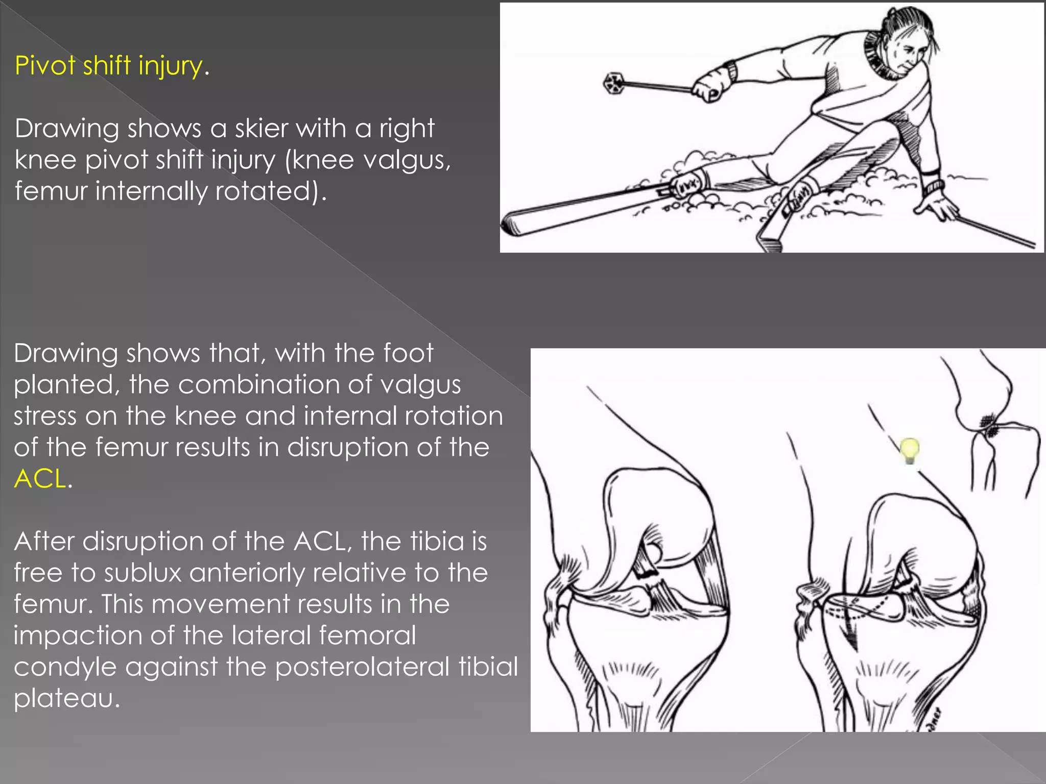 Mri knee trauma | PPTX