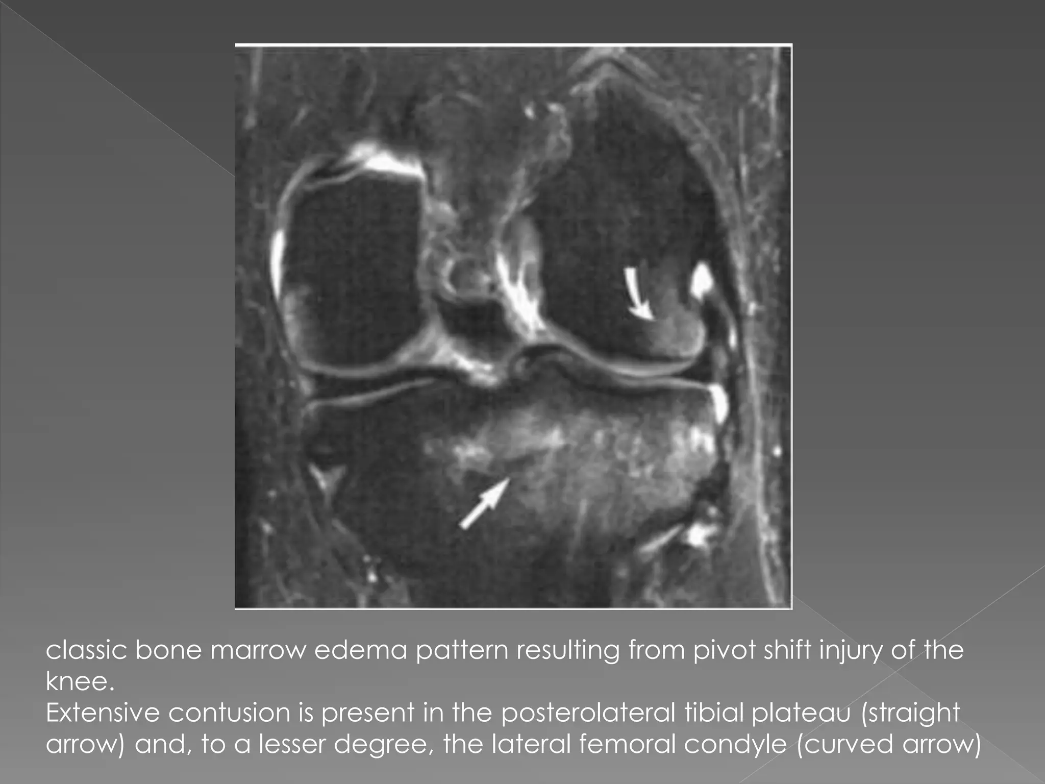 Mri knee trauma | PPTX