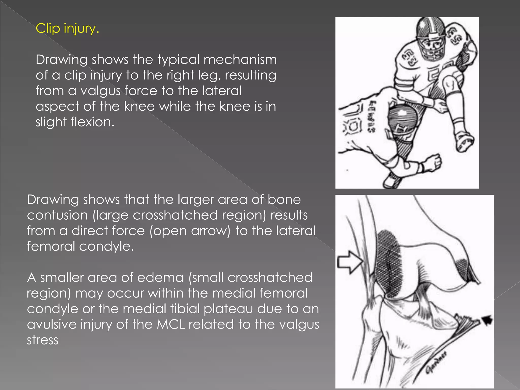 Mri knee trauma | PPTX