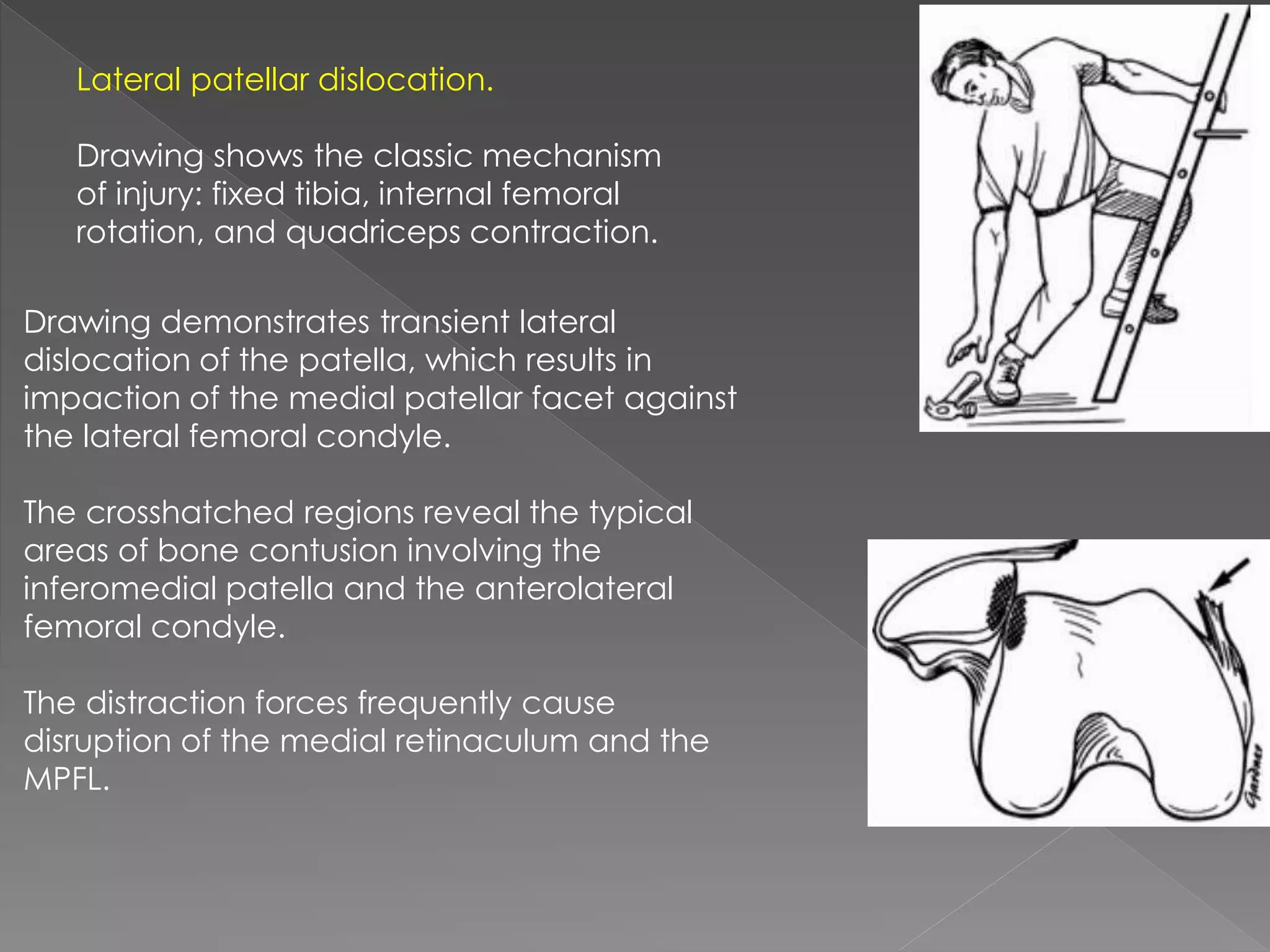 Mri knee trauma | PPTX