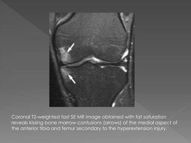 Mri knee trauma | PPTX