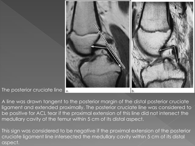 Mri knee trauma | PPTX