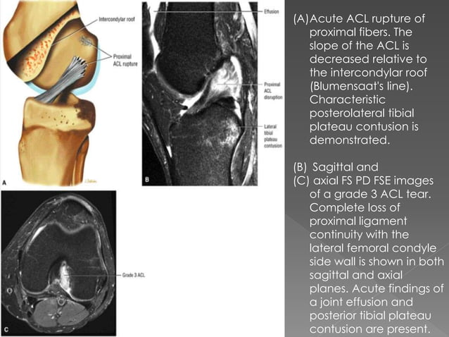 Mri knee trauma | PPTX