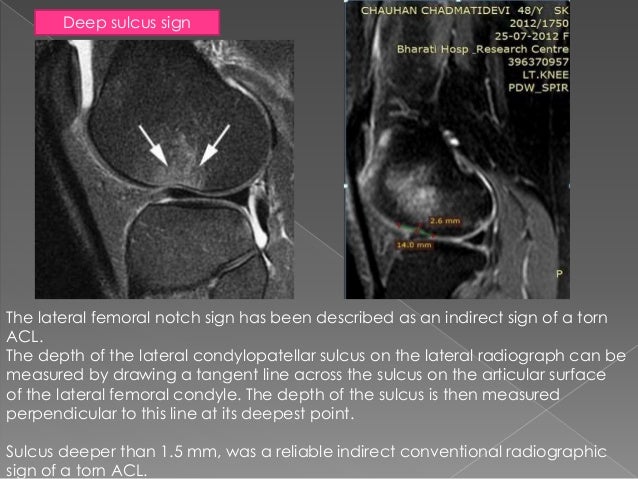 Mri knee trauma