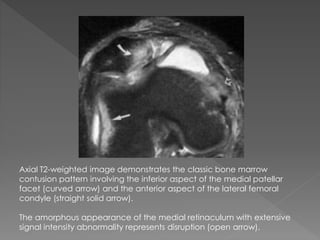 MRI Knee trauma | PPTX