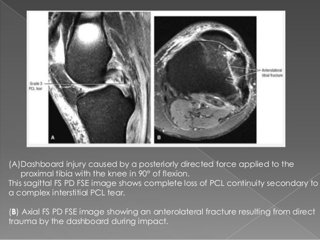 MRI Knee trauma