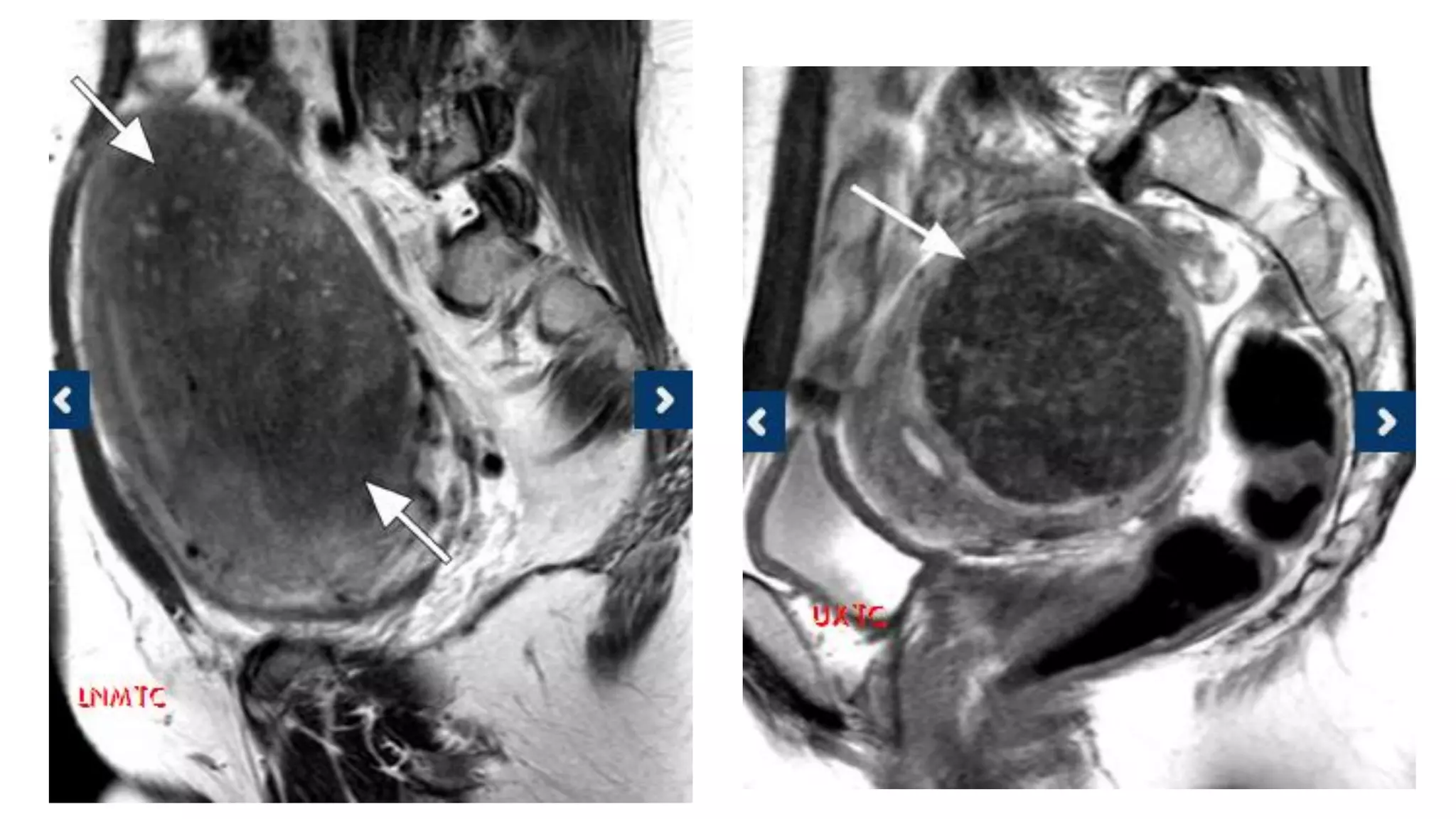 Mri lac noi mac tu cung.endometriosis.adenomyosis dr duong. 8.12.2020