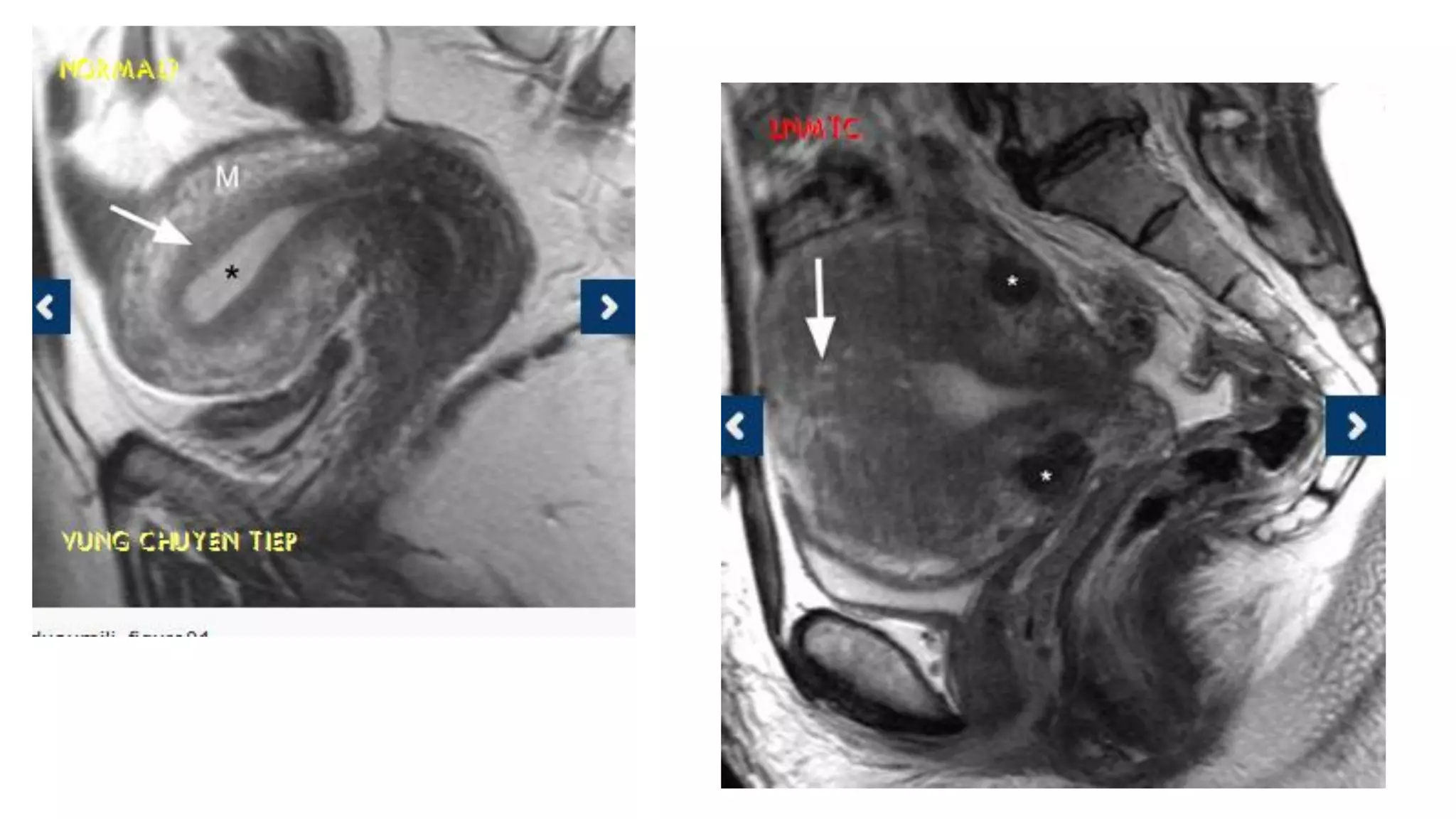Mri lac noi mac tu cung.endometriosis.adenomyosis dr duong. 8.12.2020