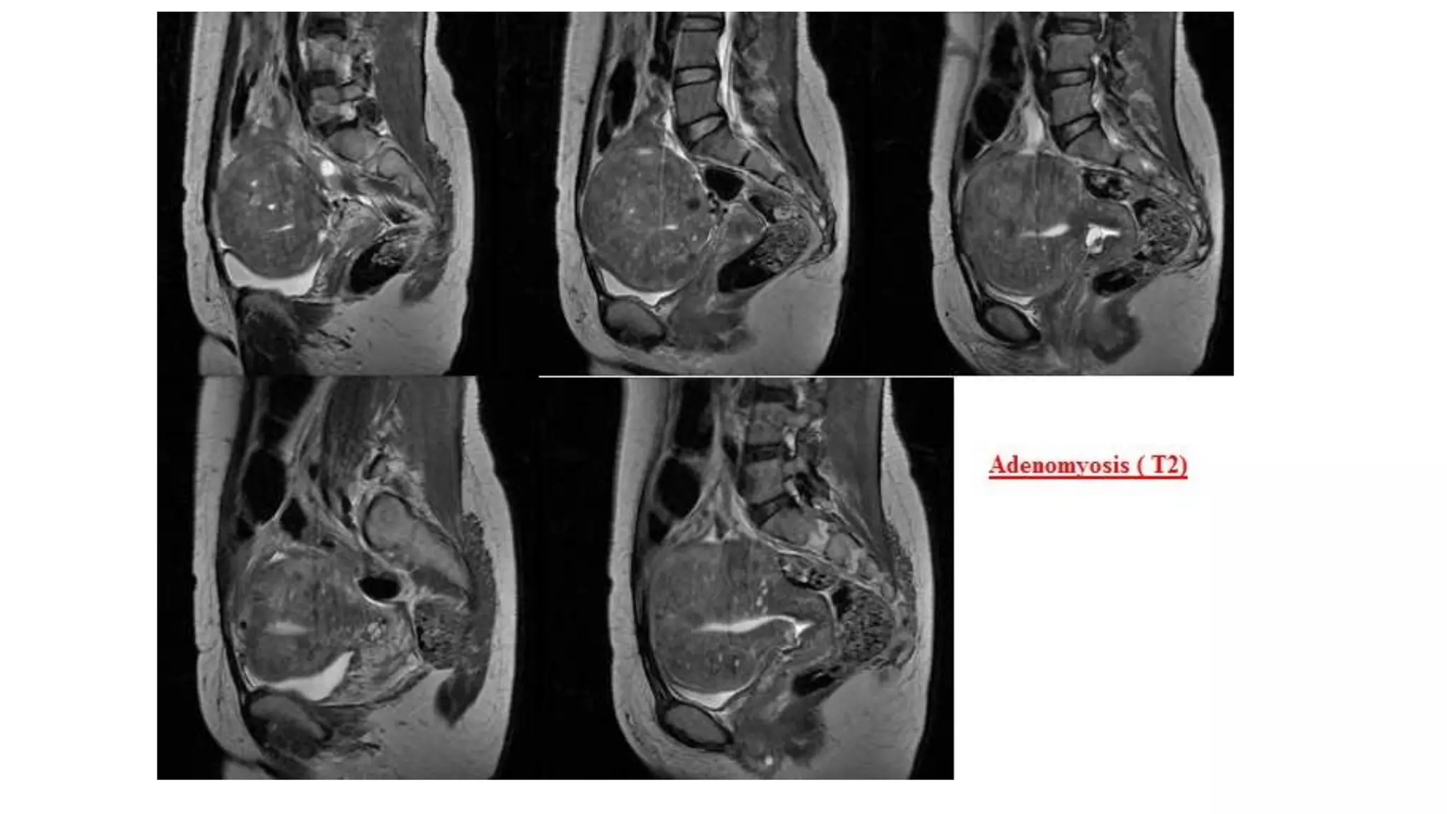 Mri lac noi mac tu cung.endometriosis.adenomyosis dr duong. 8.12.2020