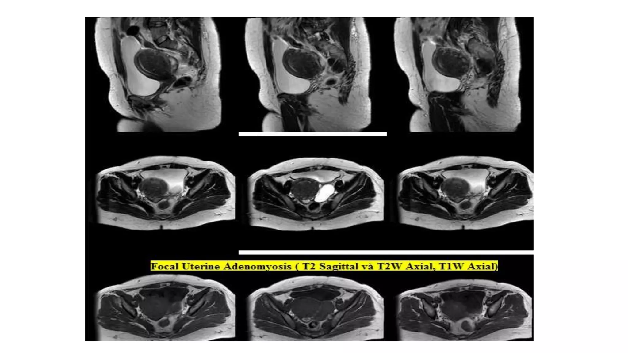 Mri lac noi mac tu cung.endometriosis.adenomyosis dr duong. 8.12.2020
