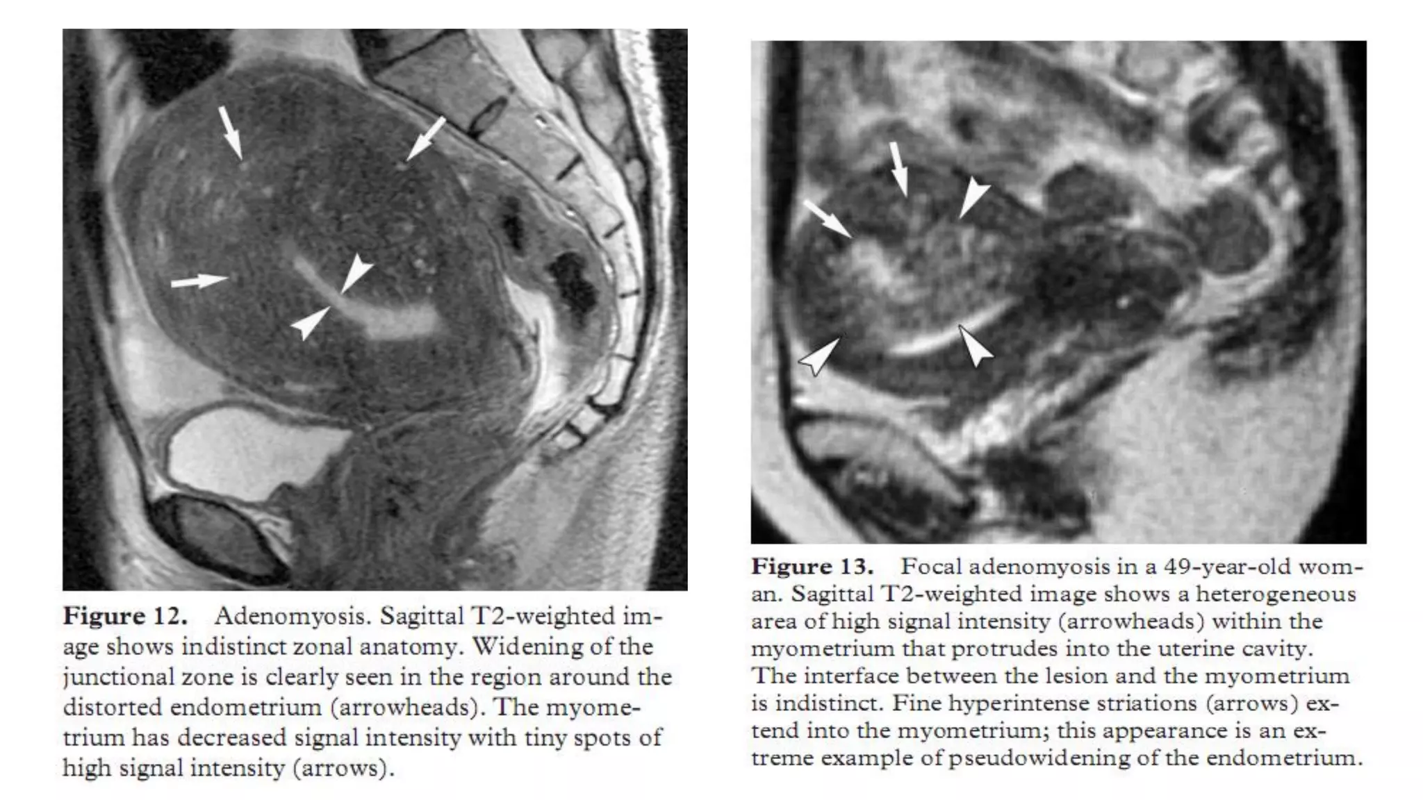 Mri lac noi mac tu cung.endometriosis.adenomyosis dr duong. 8.12.2020
