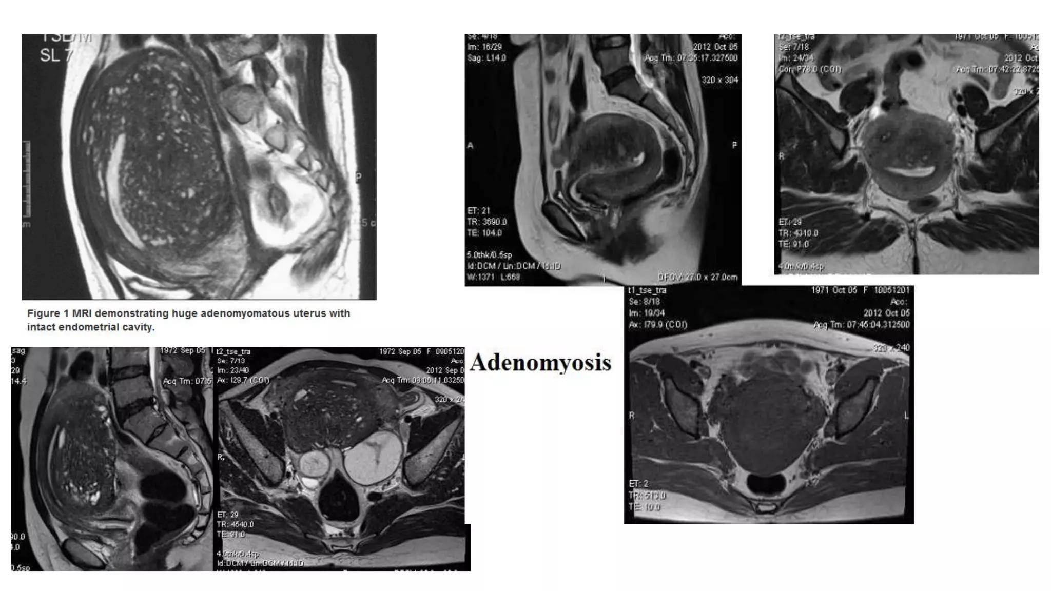 Mri lac noi mac tu cung.endometriosis.adenomyosis dr duong. 8.12.2020
