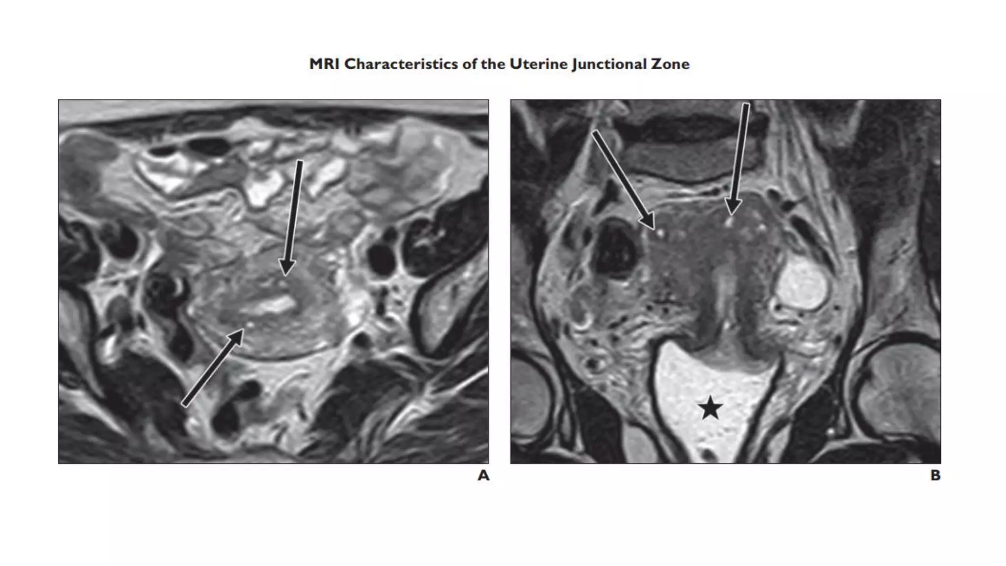 Mri lac noi mac tu cung.endometriosis.adenomyosis dr duong. 8.12.2020
