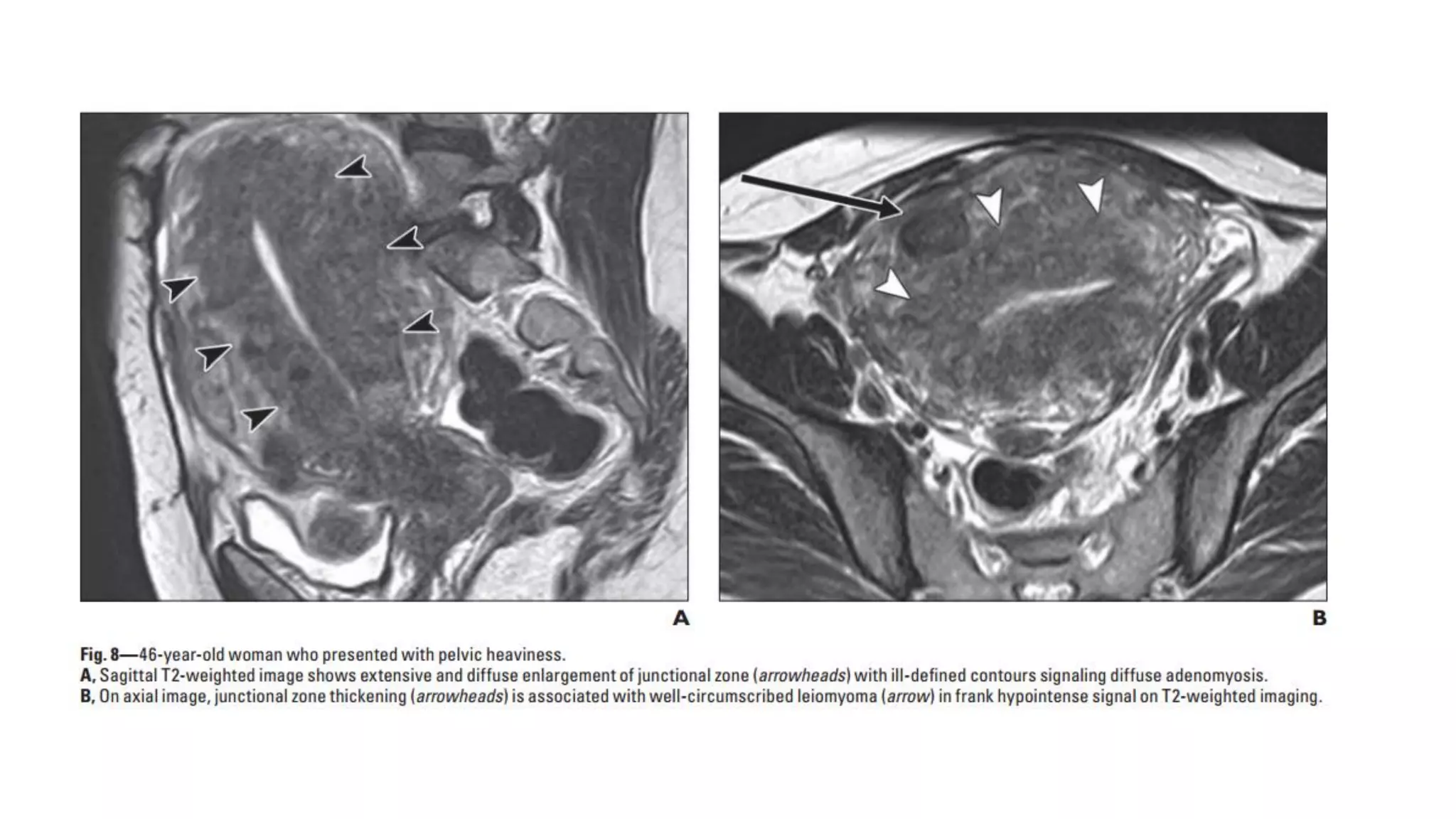 Mri lac noi mac tu cung.endometriosis.adenomyosis dr duong. 8.12.2020