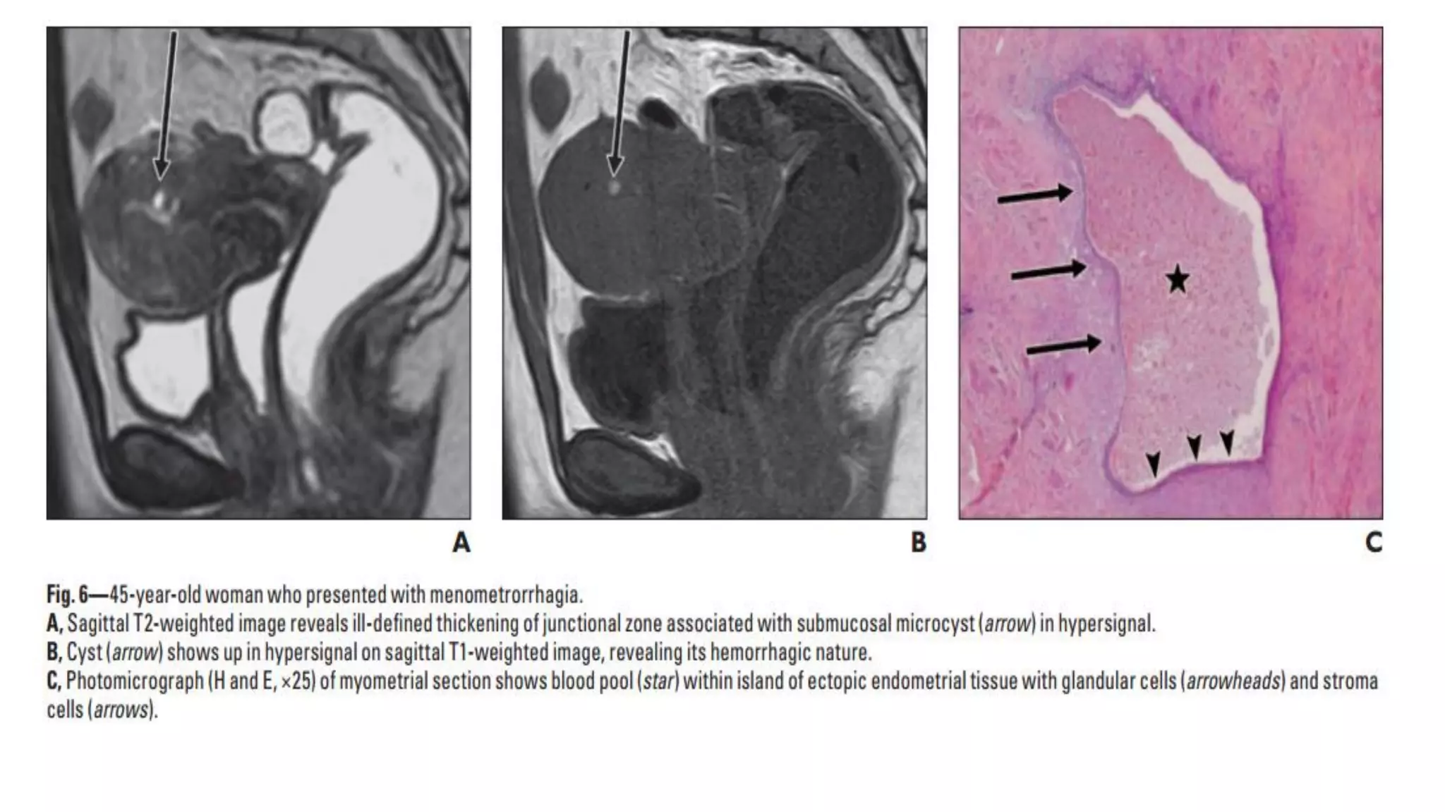 Mri lac noi mac tu cung.endometriosis.adenomyosis dr duong. 8.12.2020