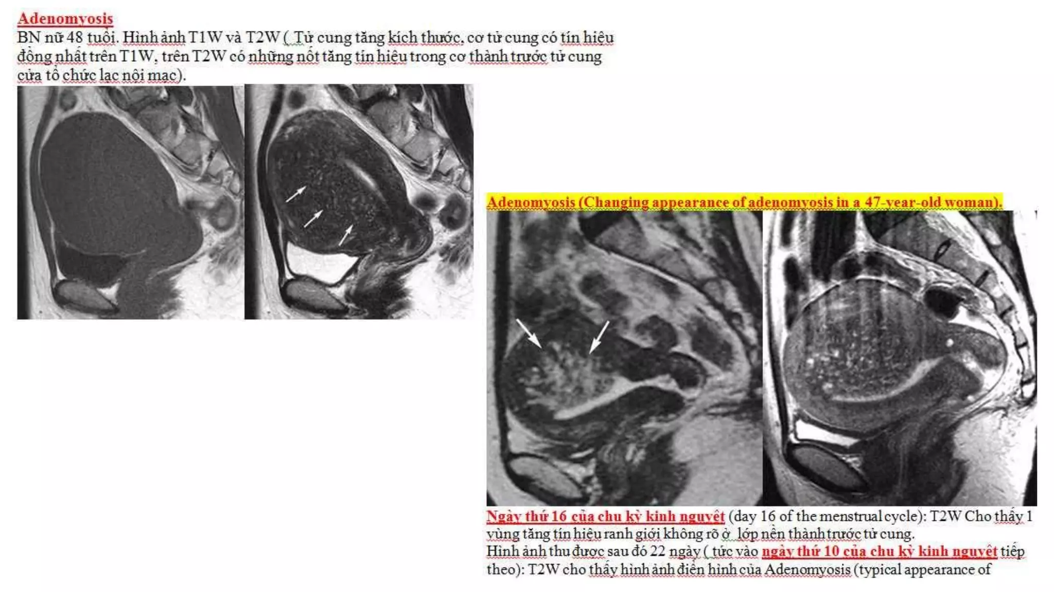 Mri lac noi mac tu cung.endometriosis.adenomyosis dr duong. 8.12.2020