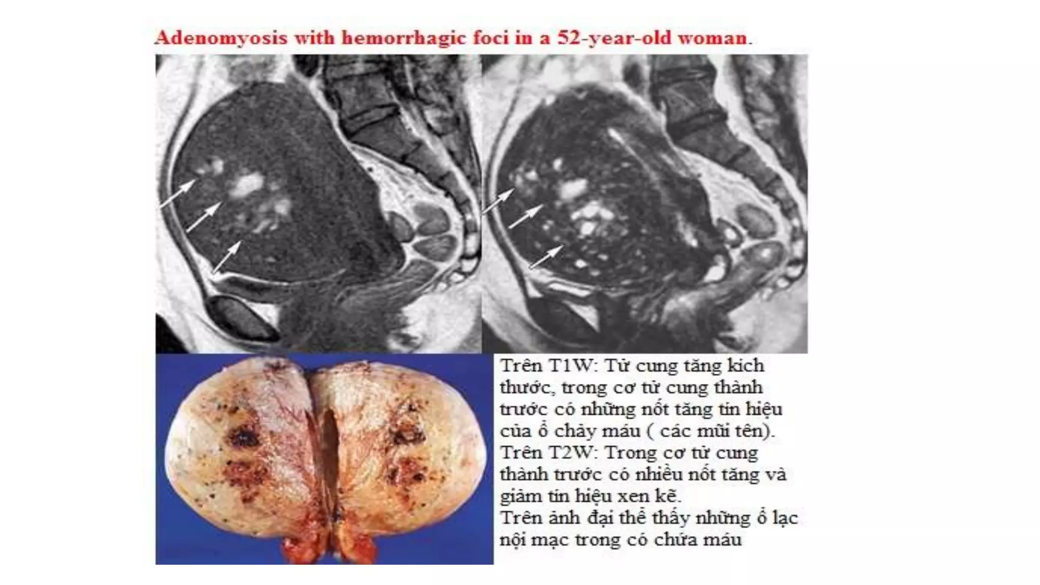 Mri lac noi mac tu cung.endometriosis.adenomyosis dr duong. 8.12.2020