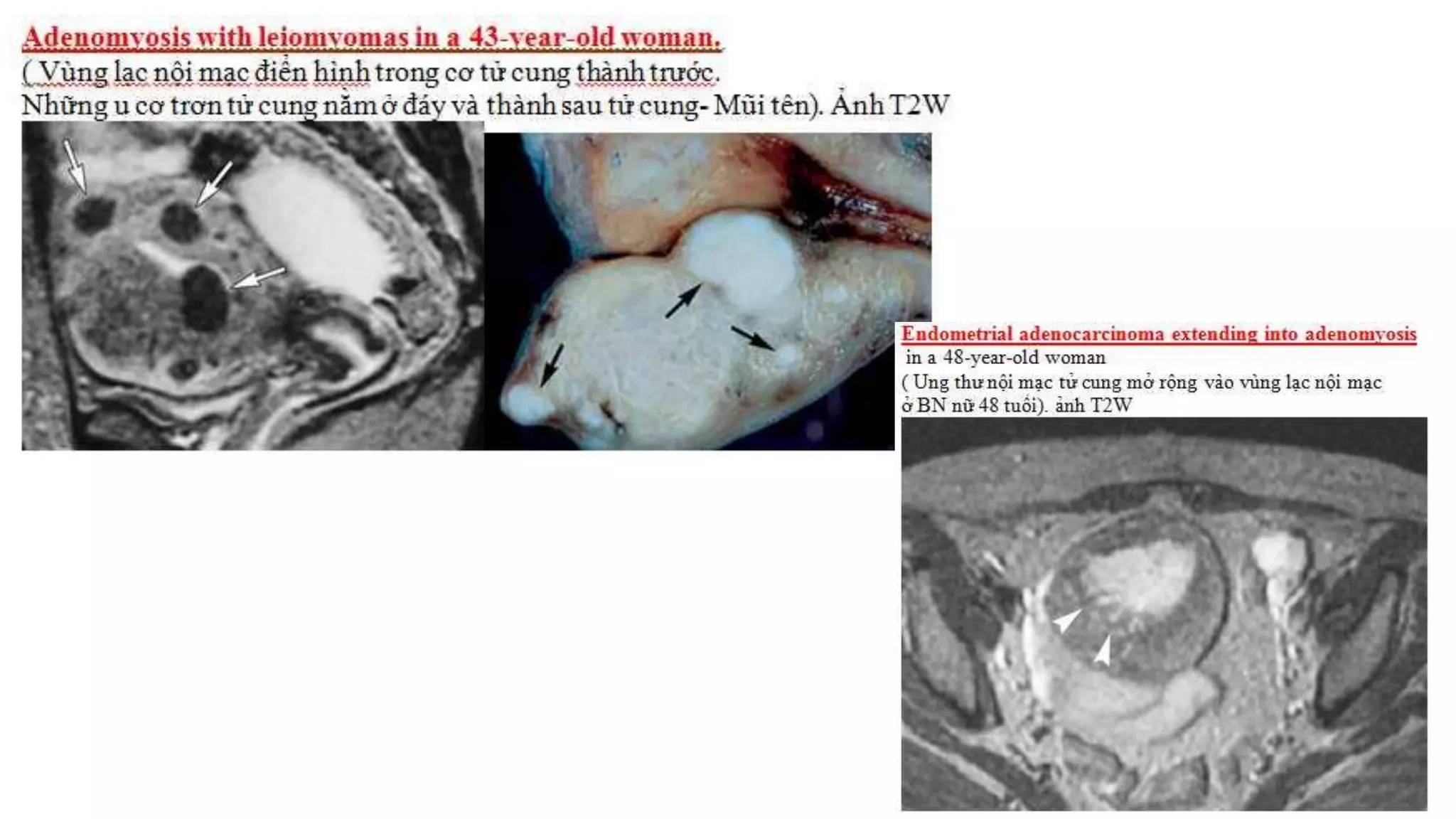Mri lac noi mac tu cung.endometriosis.adenomyosis dr duong. 8.12.2020