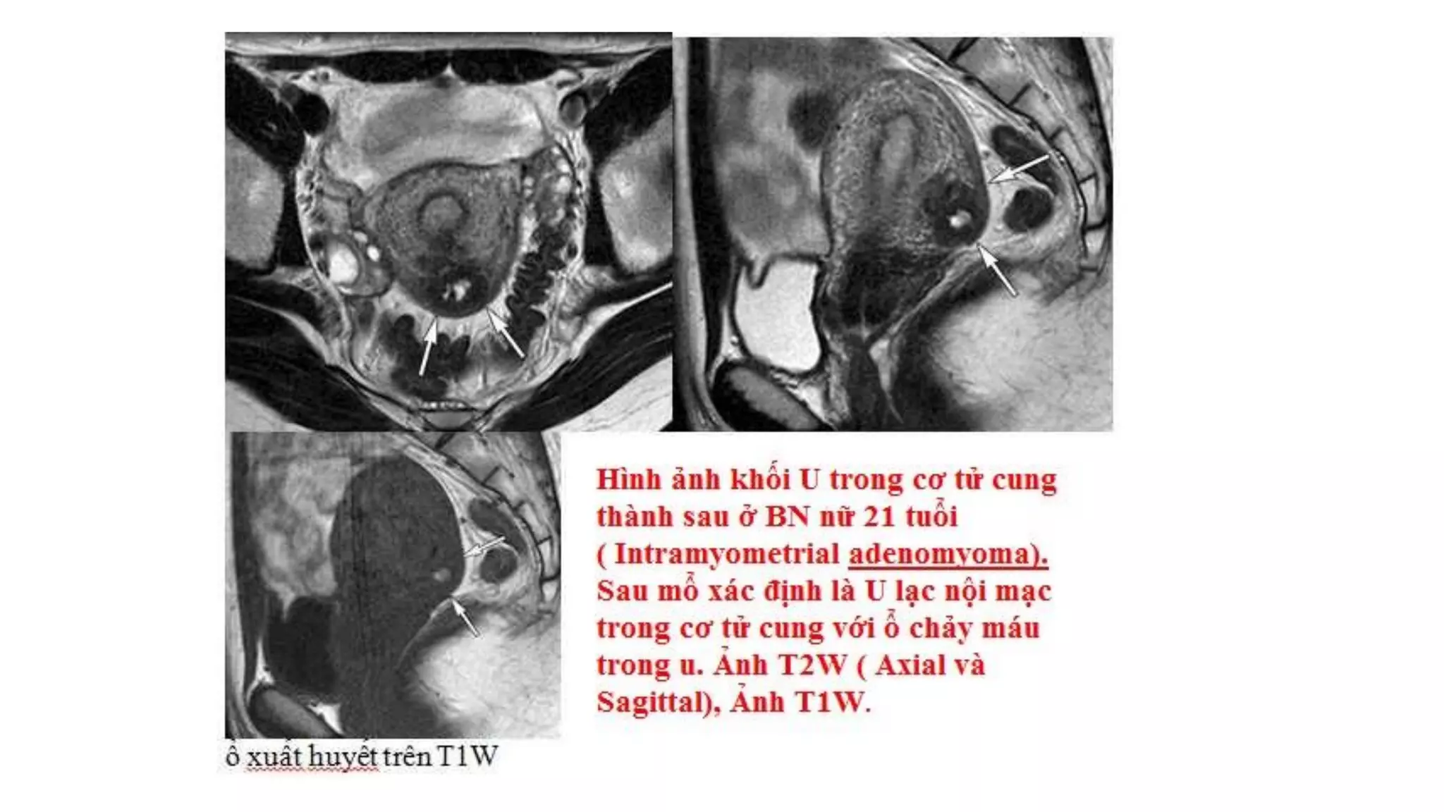 Mri lac noi mac tu cung.endometriosis.adenomyosis dr duong. 8.12.2020