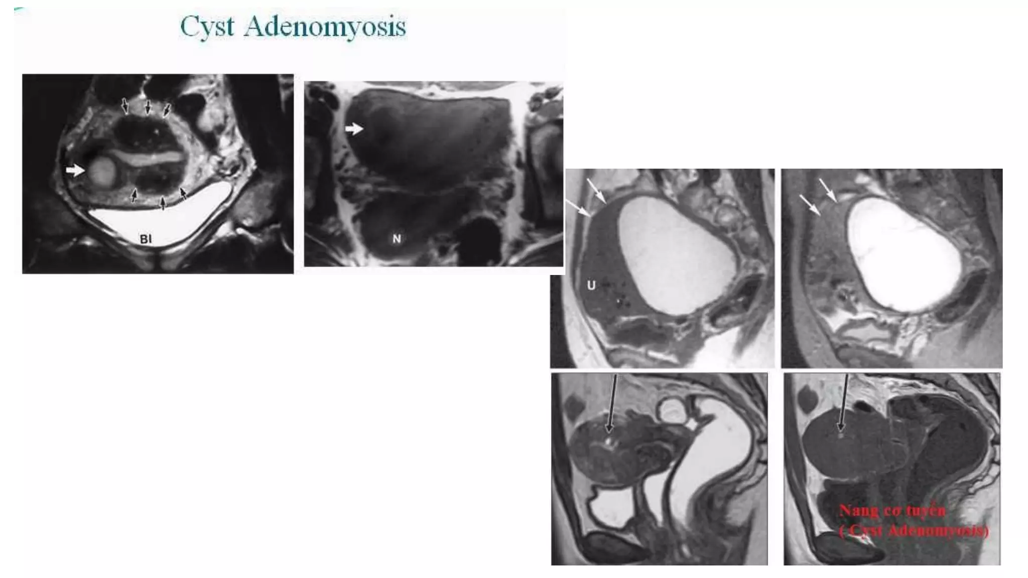 Mri lac noi mac tu cung.endometriosis.adenomyosis dr duong. 8.12.2020