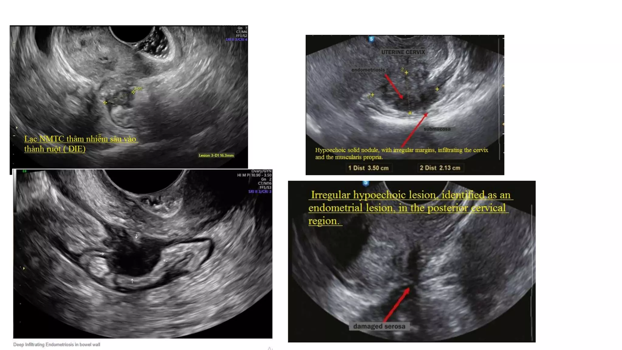Mri lac noi mac tu cung.endometriosis.adenomyosis dr duong. 8.12.2020