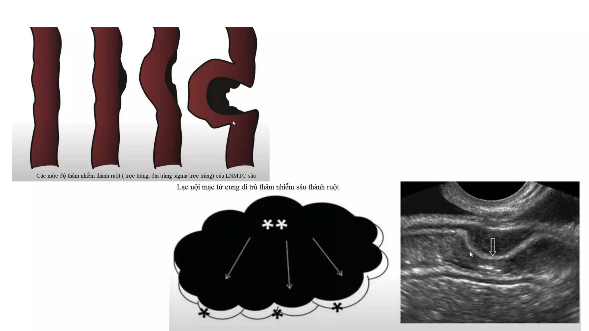 Mri lac noi mac tu cung.endometriosis.adenomyosis dr duong. 8.12.2020