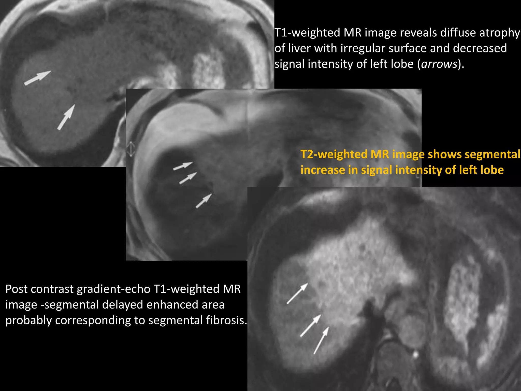 MR imaging of liver | PPTX
