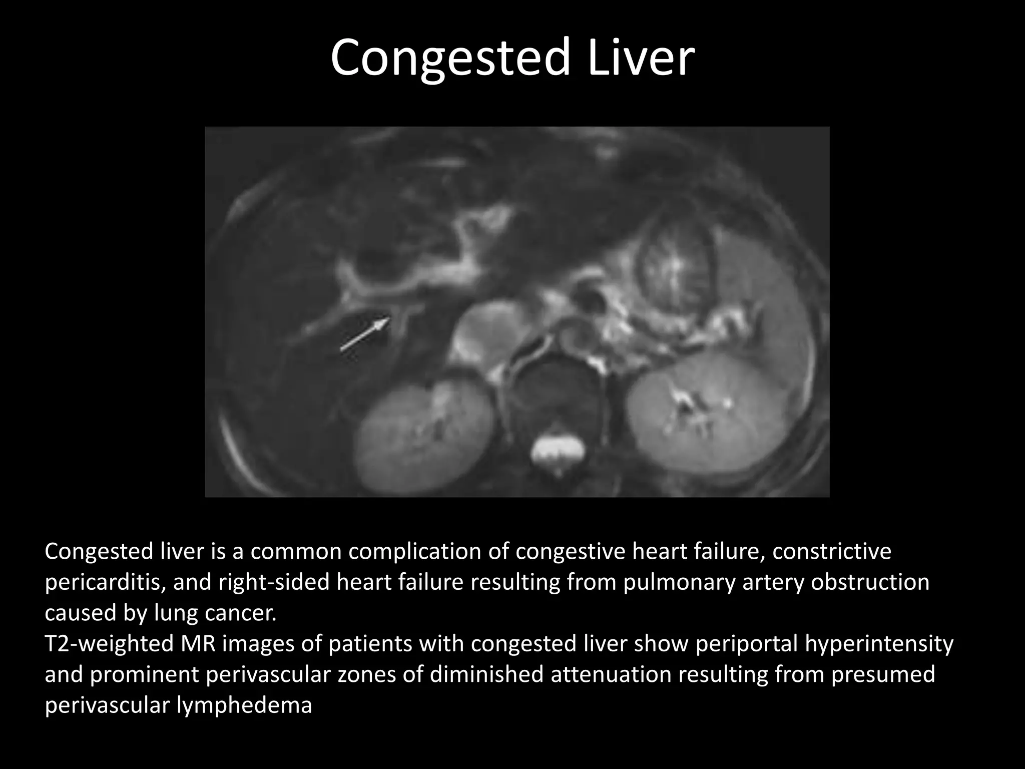MR imaging of liver | PPTX
