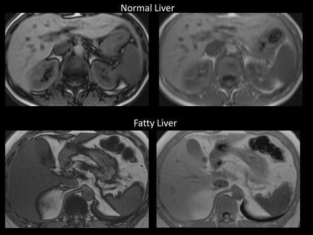 MR imaging of liver | PPTX | Endocrine and Metabolic Diseases ...