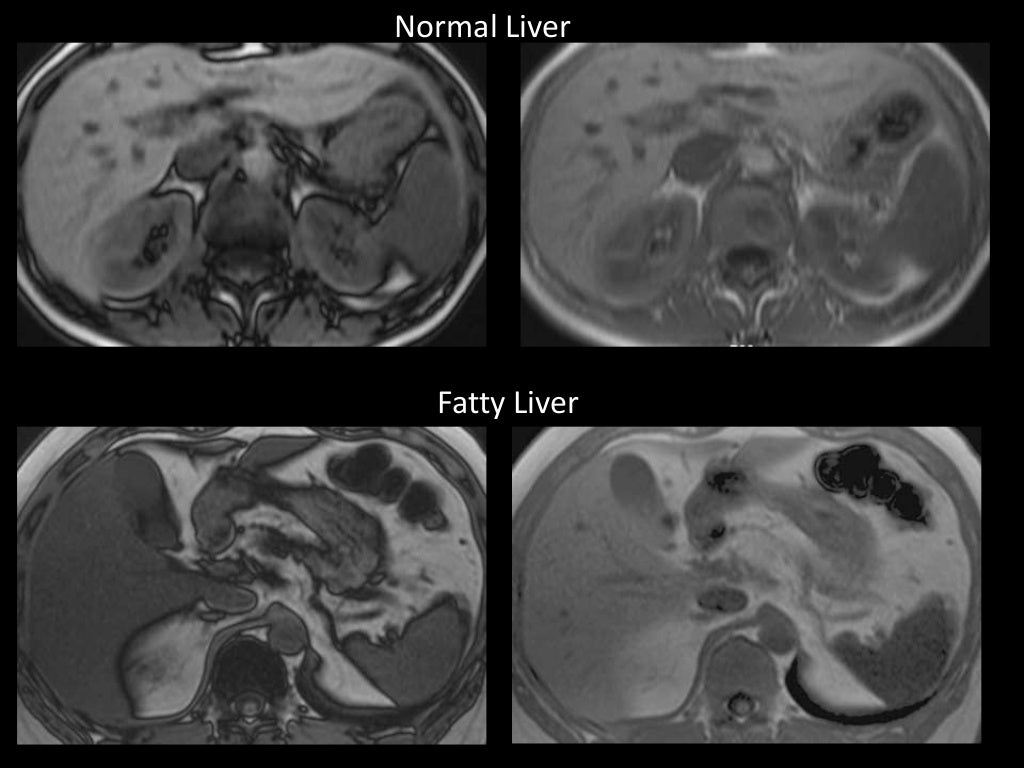 MR imaging of liver