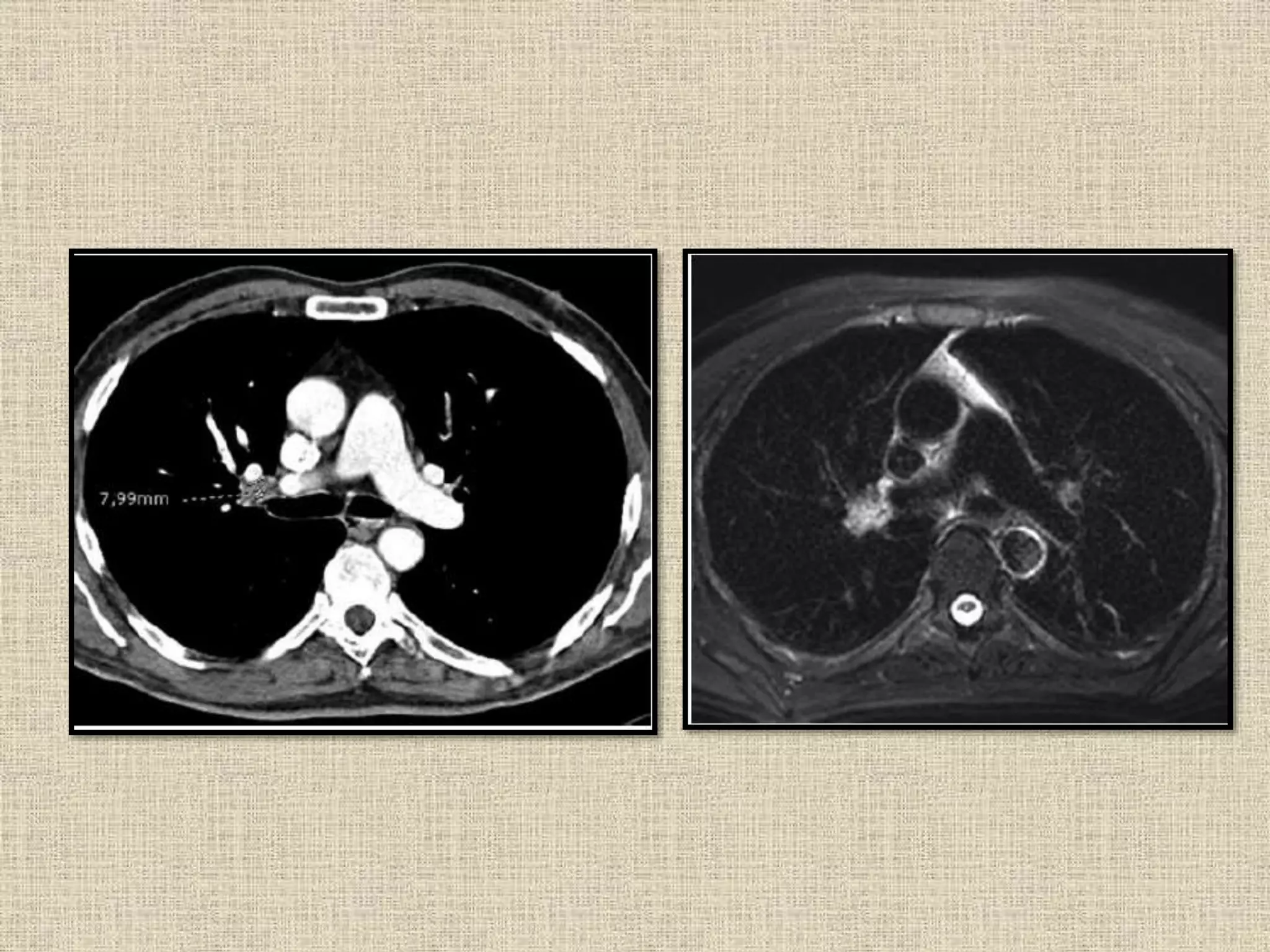 MRI lungs | PPTX