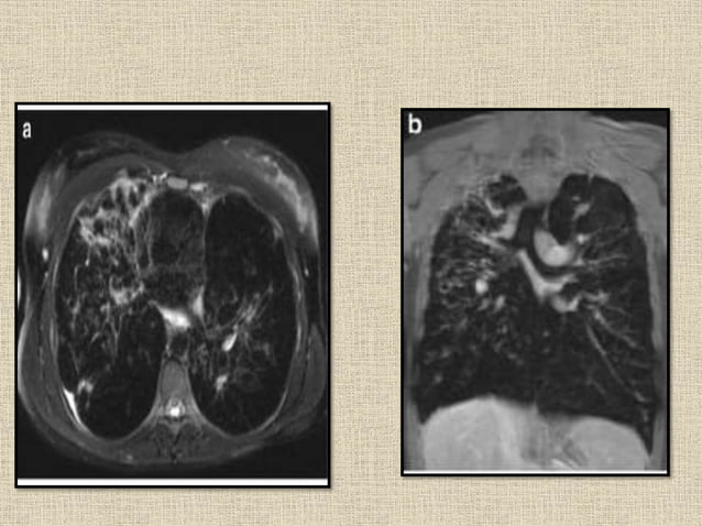 MRI lungs | PPTX | Lung and Respiratory Health | Diseases and Conditions