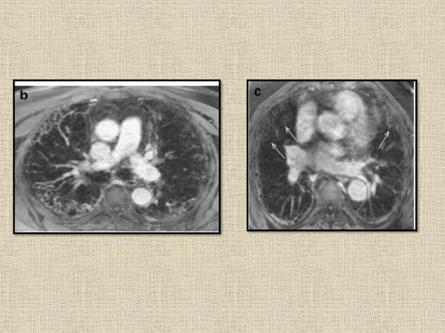 MRI lungs | PPTX | Lung and Respiratory Health | Diseases and Conditions