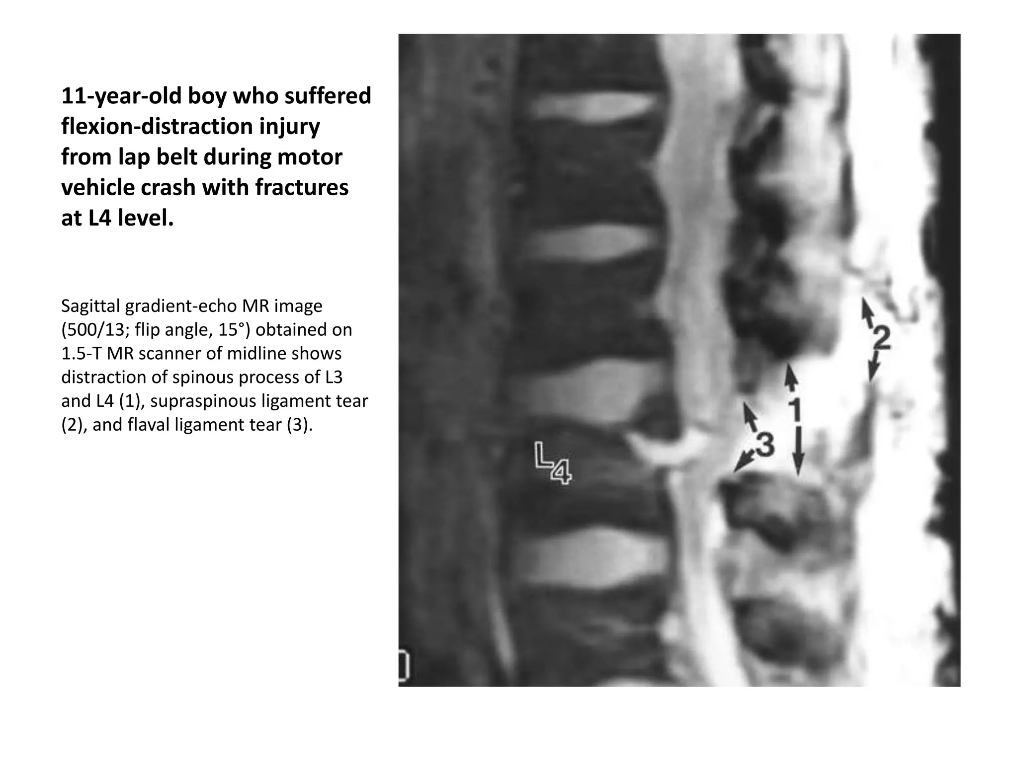 Mr imaging findings in spinal ligamentous injury | PPTX