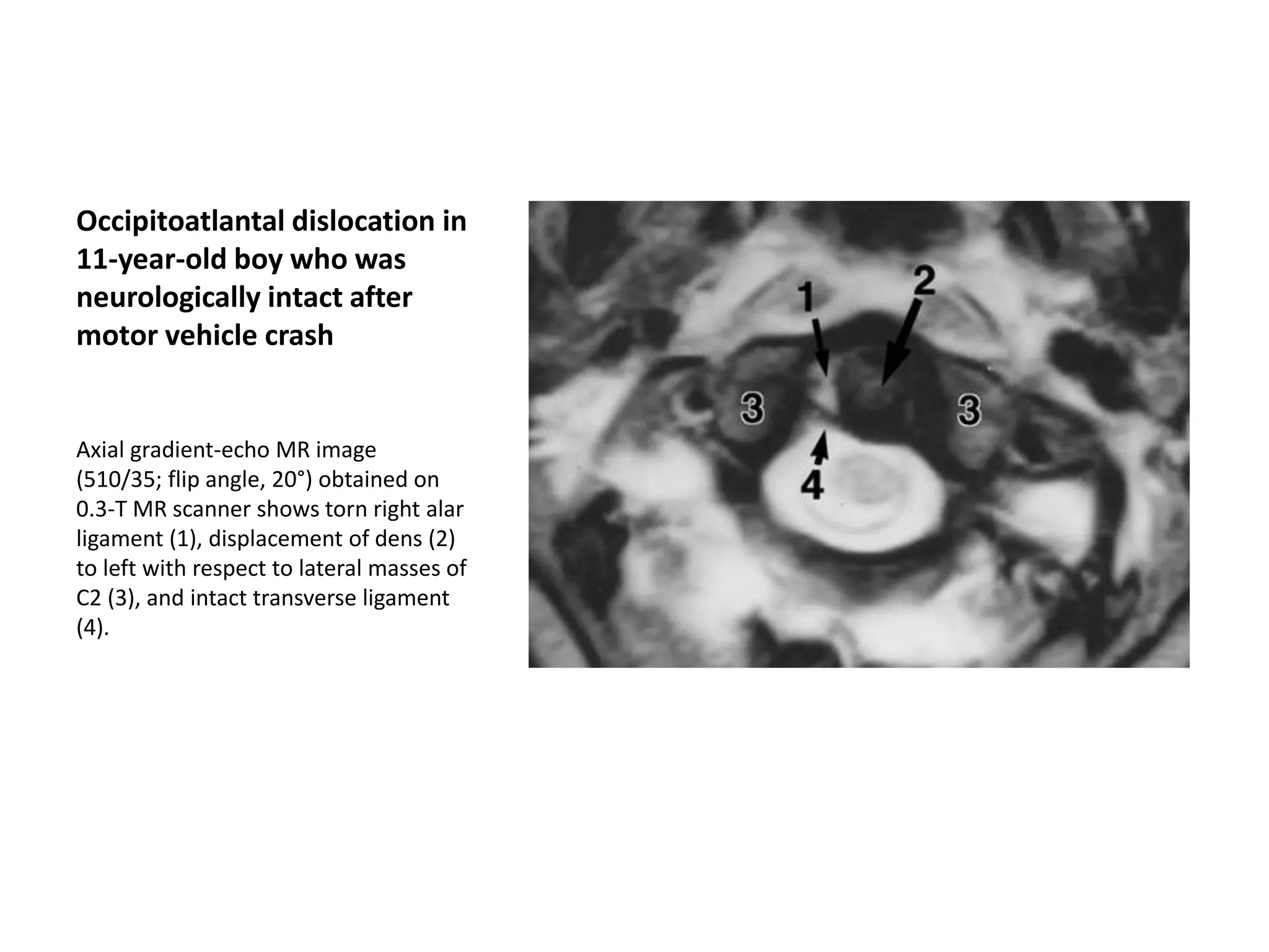 Mr imaging findings in spinal ligamentous injury | PPTX