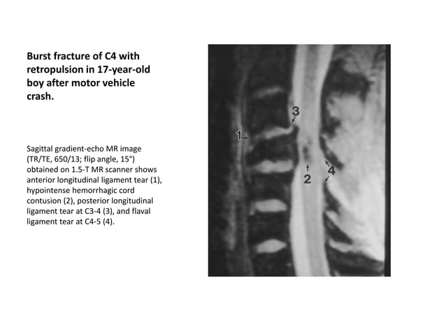 Mr imaging findings in spinal ligamentous injury | PPTX
