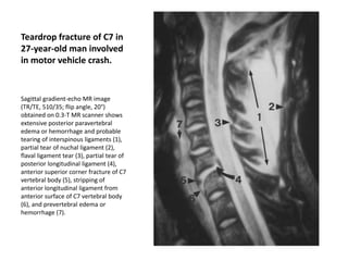 Mr imaging findings in spinal ligamentous injury | PPTX