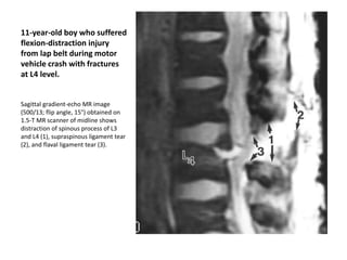 Mr imaging findings in spinal ligamentous injury | PPTX