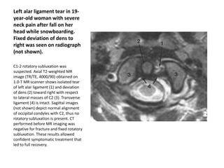 Mr imaging findings in spinal ligamentous injury | PPTX