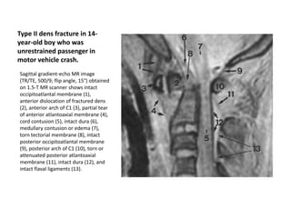 Mr imaging findings in spinal ligamentous injury | PPTX