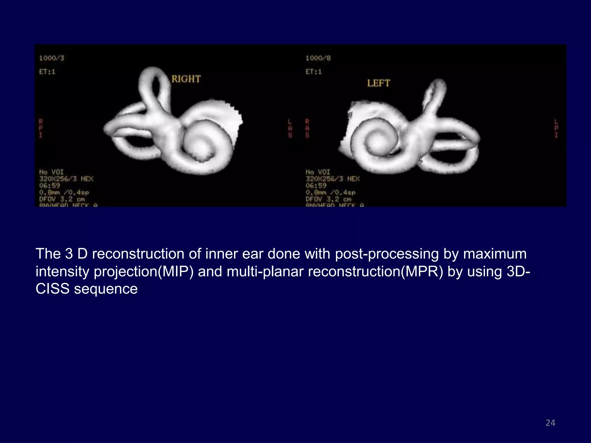 Magnetic Resonance Imaging Of Inner Ear | PPTX