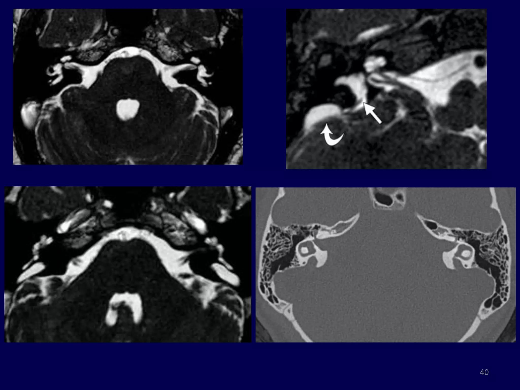 Magnetic Resonance Imaging Of Inner Ear | PPTX