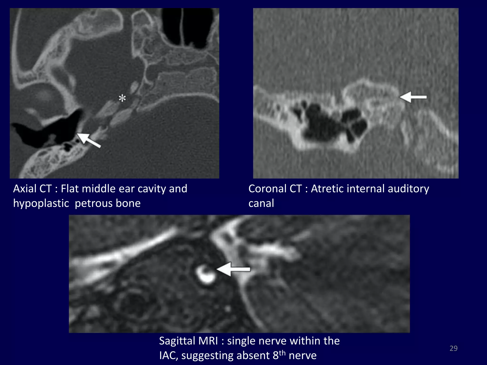 Magnetic Resonance Imaging Of Inner Ear
